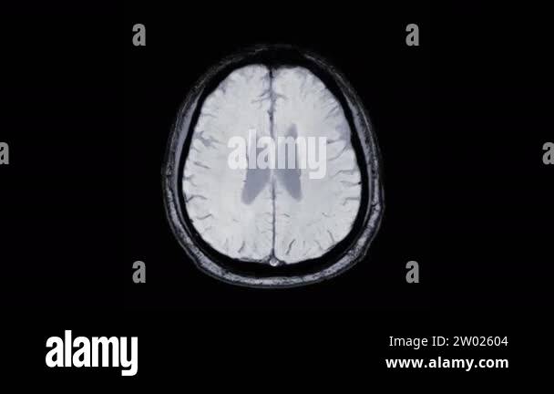 MRI Brain minimum in-phase axial view for detect stroke disease and ...