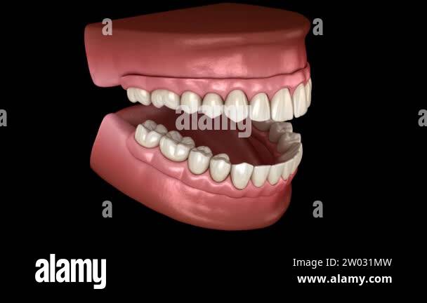 Maxillary prosthesis All on 4 system supported by implants. Medically ...