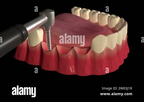 This video shows the procedure for implant supported dental bridges to replace a missing tooth ...