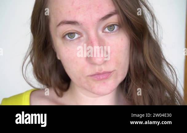 Allergic to food Stock Videos & Footage - HD and 4K Video Clips - Alamy