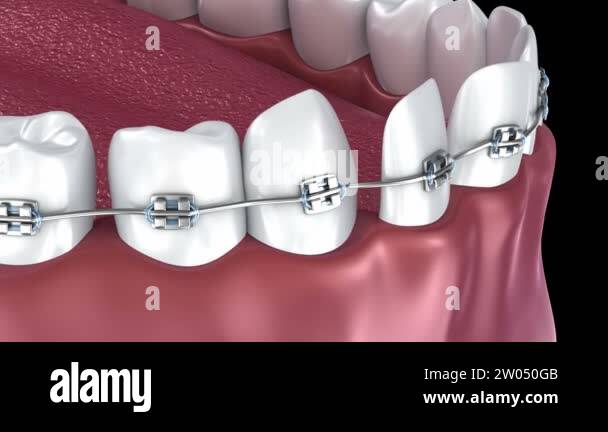 3d render teeth braces Stock Videos & Footage - HD and 4K Video Clips ...