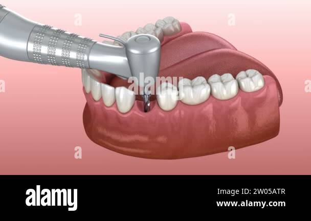 Implantation process in details: 3D animation of Drilling, implantat ...