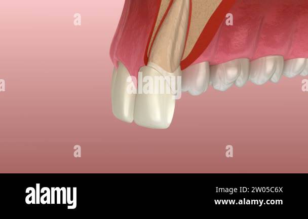 Veneer installation procedure over central incisor and lateral incisor ...
