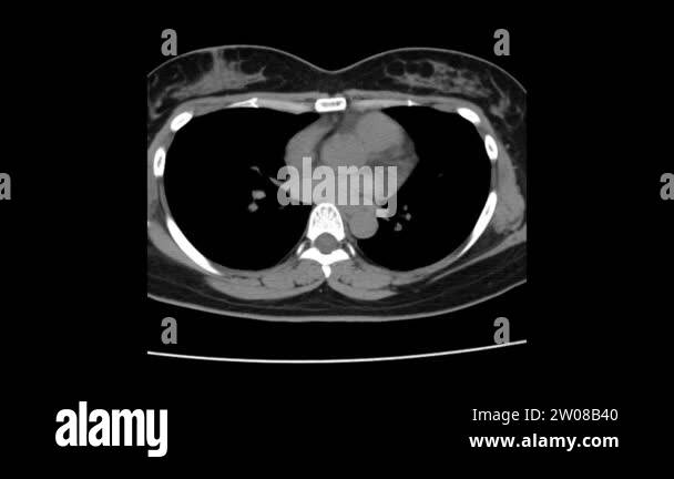 Cta of abdomen Stock Videos & Footage - HD and 4K Video Clips - Alamy