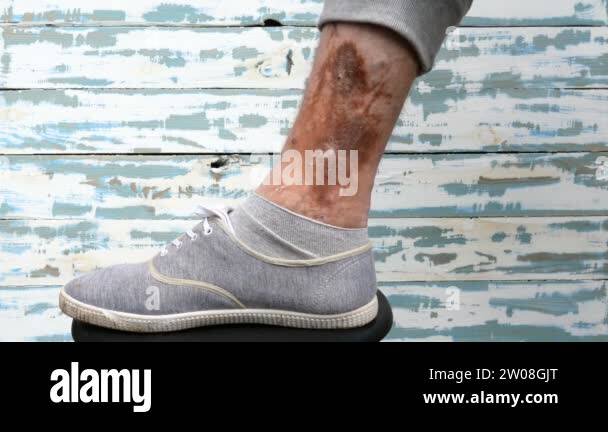 Bad leg and Illness of human skin. Scratch scars, ulcers and age spots ...