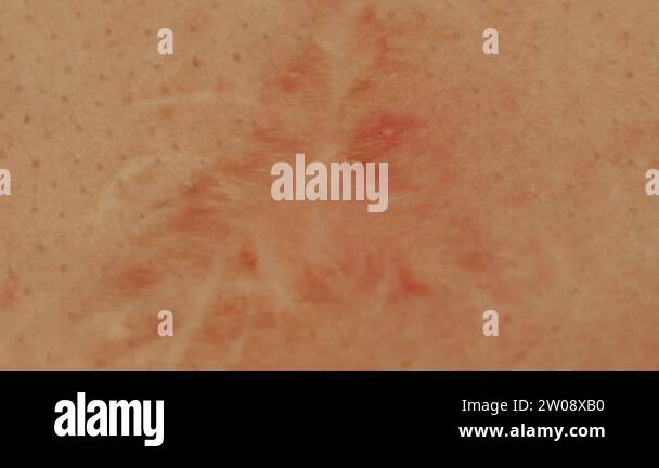 Male body scar Stock Videos & Footage - HD and 4K Video Clips - Alamy