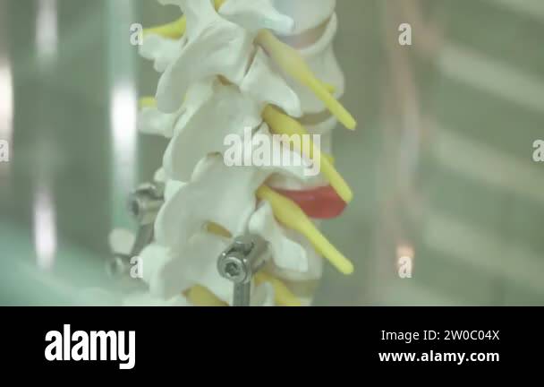 Example of human spine prosthetics with metal prostheses standing in a ...