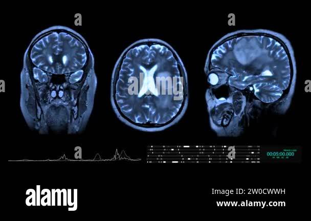 Brain mri Stock Videos & Footage - HD and 4K Video Clips - Alamy