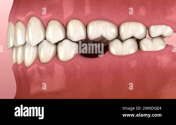 Teeth shift deformatiuon after losing molar tooth. 3D animation of ...
