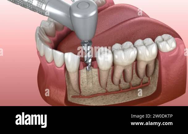 Implantation process in details: 3D animation of Drilling, implantat ...