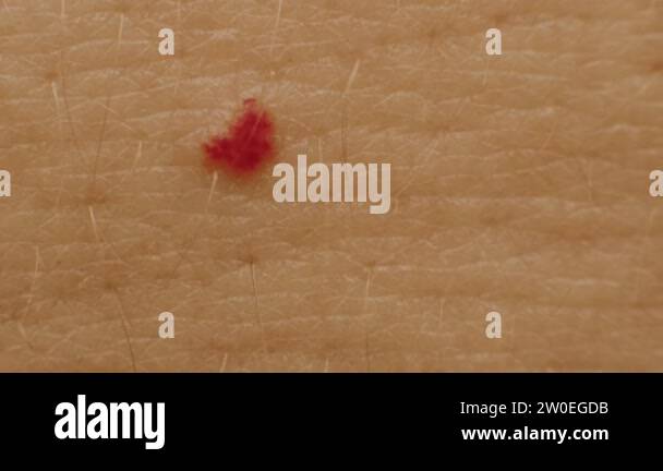 red moles on the patient s skin, hemangioma, angioneuromas, copy space ...