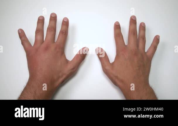 Comparison of two male hands stung by bee or wasp. Hand swelling ...