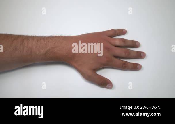 Male hand stung by bee or wasp. Hand swelling, inflammation, redness ...