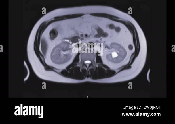 MRCP or Magnetic resonance cholangiopancreatography axial view showing ...