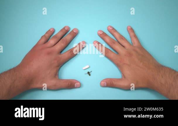 Male hand stung by bee and medication for swelling next to it. Hand ...