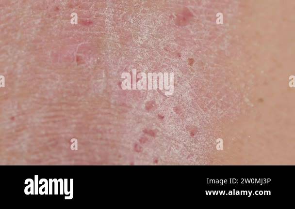 psoriasis: the area of the skin of the back of a person affected by ...