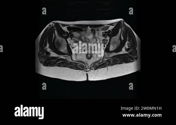 Contrast MRI scan of the abdominal cavity and retroperitoneal space ...