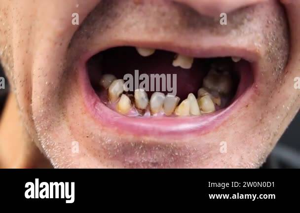 The man has rotten teeth, teeth fell out, yellow and black teeth hurt ...