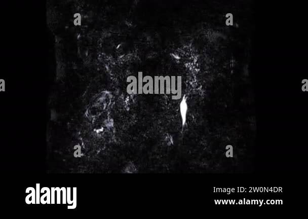 Magnetic resonance cholangiopancreatography or MRCP 3D Coronal MIP view ...