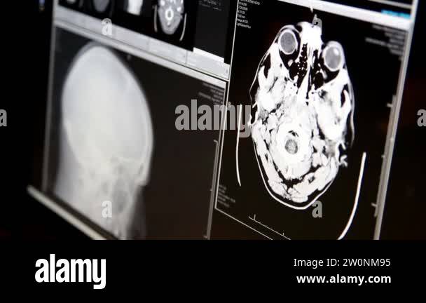A doctor examines a head MRI scan on a computer screen Stock Video ...