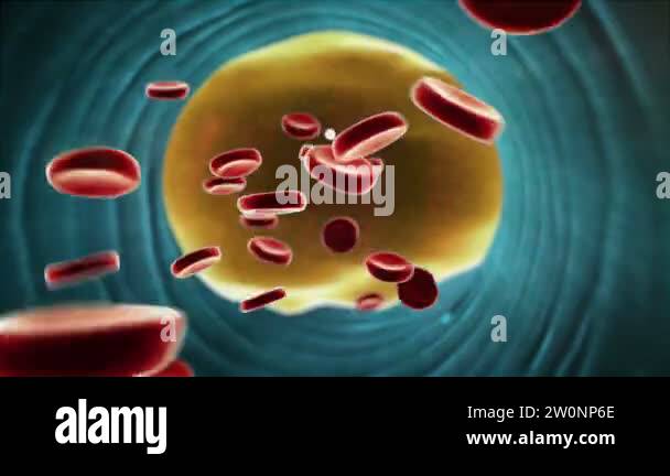 fatty plaques in the artery, Contraction of blood vessels, a blood clot ...