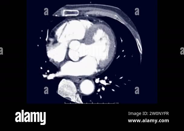 CTA Coronary artery or CT Angiography of the heart in Axial view slow ...