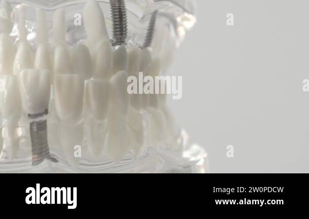 Screwed dental implants in the jaw. Concept of modern procedure in ...