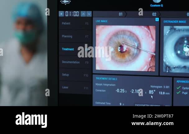 Ophthalmic surgery. View on the screen of medical monitor in operating ...