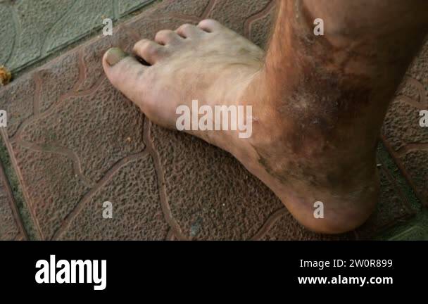 Human skin disease. Person s foot that is affected by dermatological ...