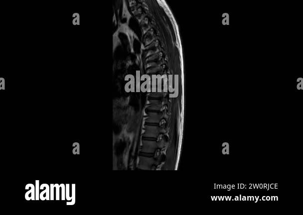 MRI scan of the thoracic ridge, detection of protrusions and hernias on ...