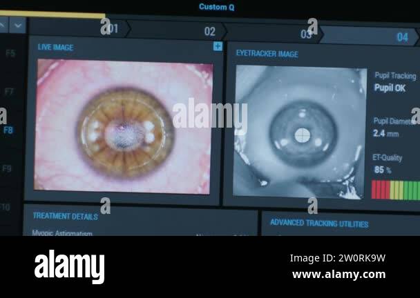 Ophthalmic surgery. View on the screen of medical monitor in operating ...