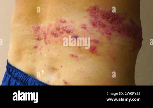 Varicella zoster back shingles Stock Videos & Footage - HD and 4K Video ...