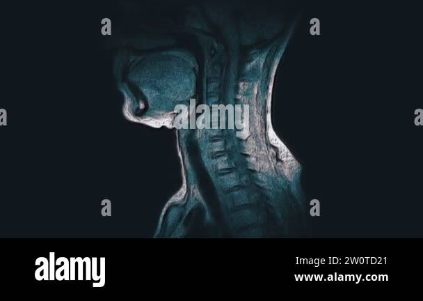 Voluminous color MRI of the cervical spine, detection of protrusions ...