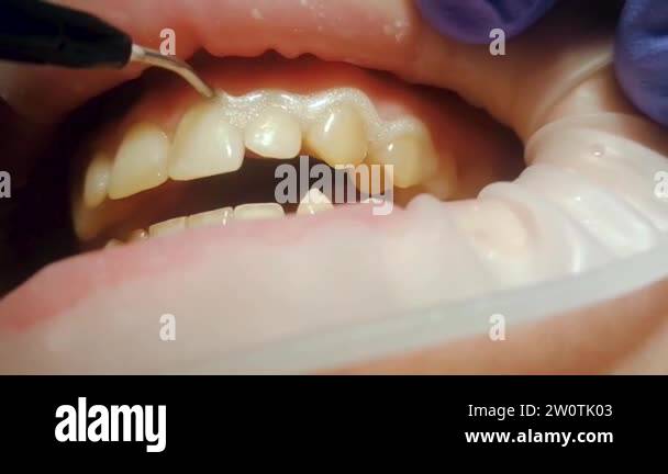 On incisors, liquid rubber dam, composite, photopolymer for bleaching ...
