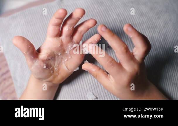 Child skin burn Stock Videos & Footage - HD and 4K Video Clips - Alamy