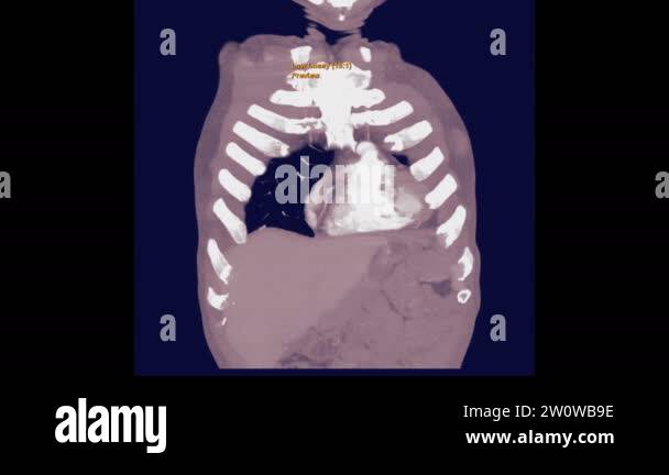 CTA for PE or pulmonary embolism , CT Chest with contrast media agent ...