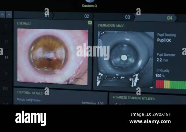 Ophthalmic surgery. View on the screen of medical monitor in operating ...