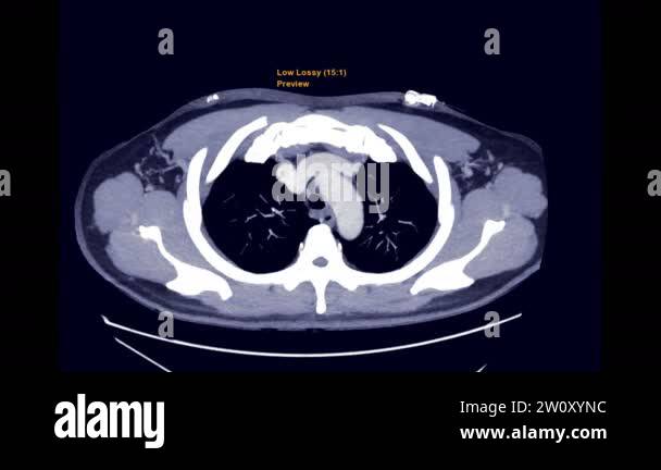 CTA for PE or pulmonary embolism , CT Chest with contrast media agent axial MIP View for detect ...
