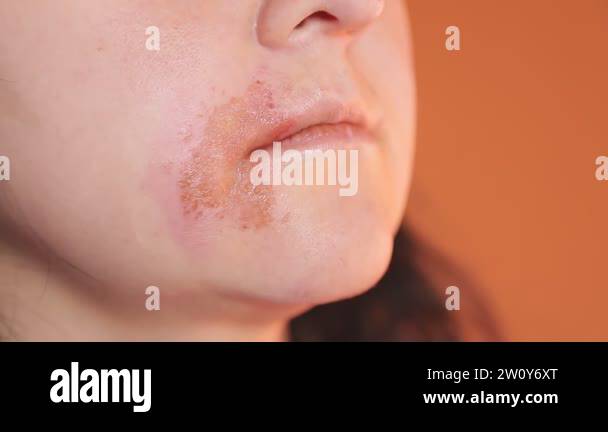 Crusty skin Stock Videos & Footage - HD and 4K Video Clips - Alamy