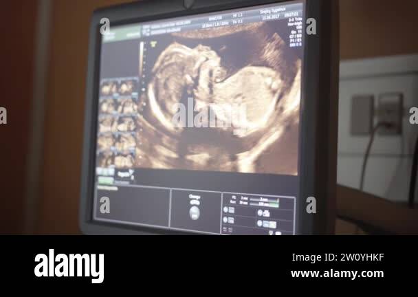 Ultrasound Machine Showing a Fetus with a Healthy Beating Heart Stock ...