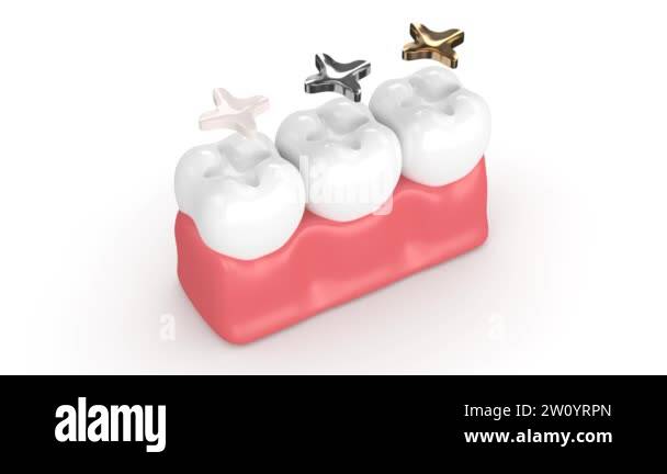 Metal inlay Stock Videos & Footage - HD and 4K Video Clips - Alamy