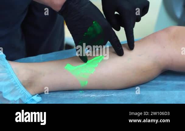 A doctor does medical procedure Sclerotherapy used to eliminate ...