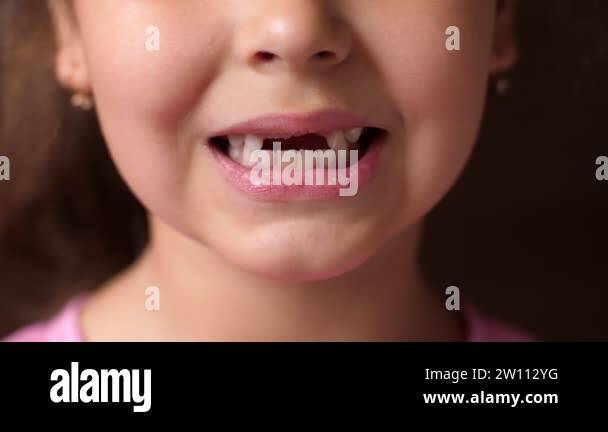 Baby teeth. Toothless smile. Cutting root tooth. The girl opens her ...