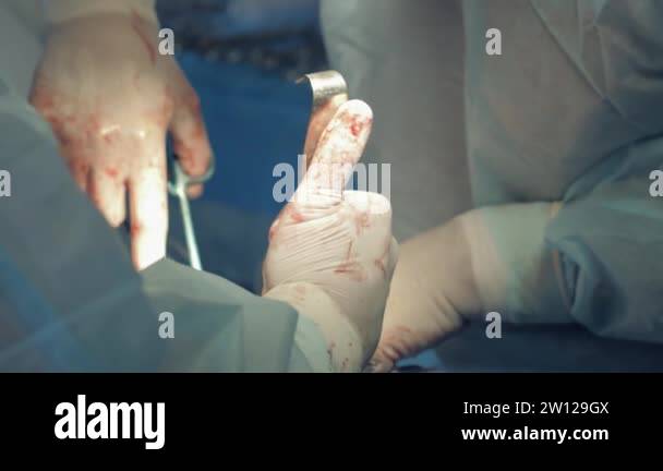 Operating surgeon performing incision Stock Videos & Footage - HD and ...