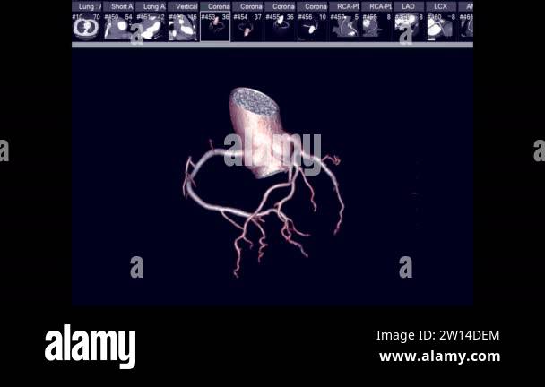 CTA Coronary artery 3D rendering image or coronary tree turn around on ...