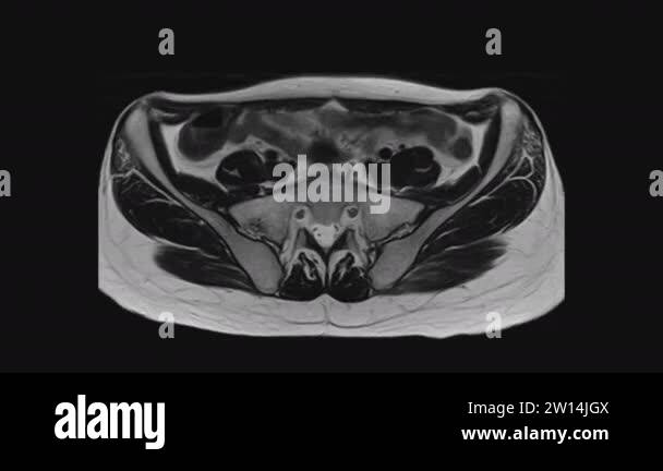 MRI of the female pelvic organs, abdominal cavity, gastrointestinal ...