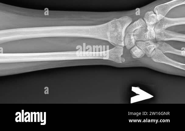 Broken human bone x ray Stock Videos & Footage - HD and 4K Video Clips ...
