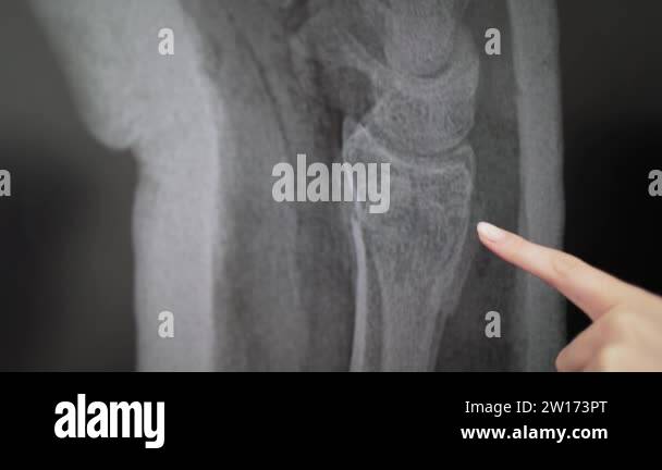 X-ray of a broken arm in a gypsum. The doctor shows the patient the ...