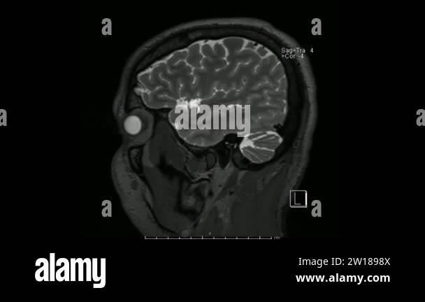 Magnetic resonance images of the brain (MRI brain) sagittal T2 weighted sequence in cine mode ...