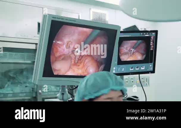 Operation by laparoscopic method with output of patient 's internal ...